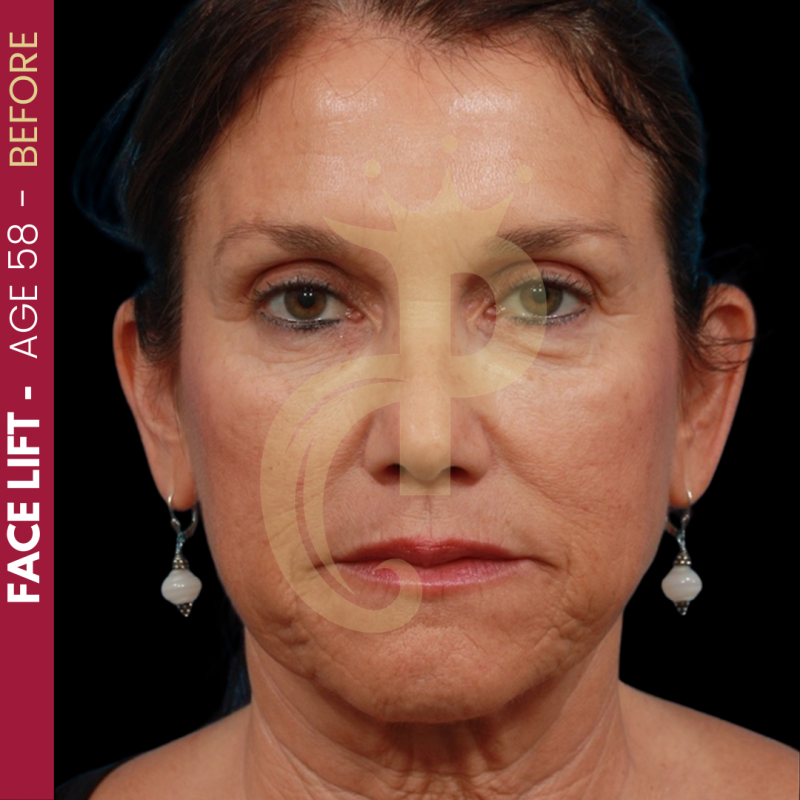 Türkiye'de Blefaroplasti: | Maliyet, Sonuç, Prosedür | Pixl Clinic