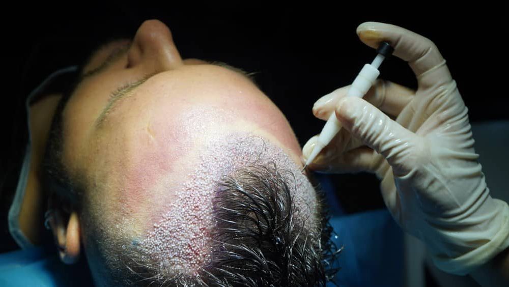 DHI Hair Transplant In Turkey | Direct & Precise Hair Restoration