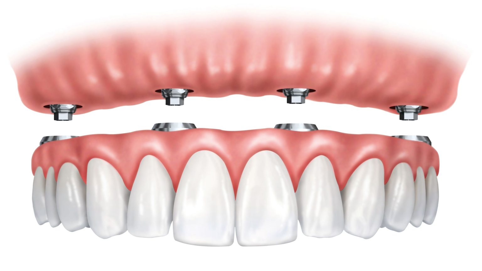 Hybrid Prosthesis In Turkey | Expert Fixed Denture Solutions