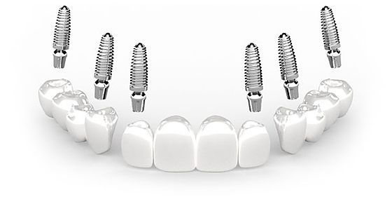 Impianti Dentali 3 Contro 6 In Turchia: Vantaggi, Costi E Tecniche