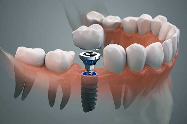 Implantes Dentales De Boca Completa En Turquía – Sonrisa Total