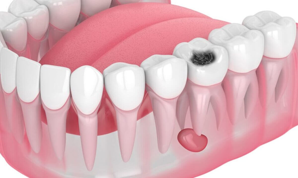 Diş Kisti Tedavisi: Belirtileri, Nedenleri Ve Tedavi Yöntemleri