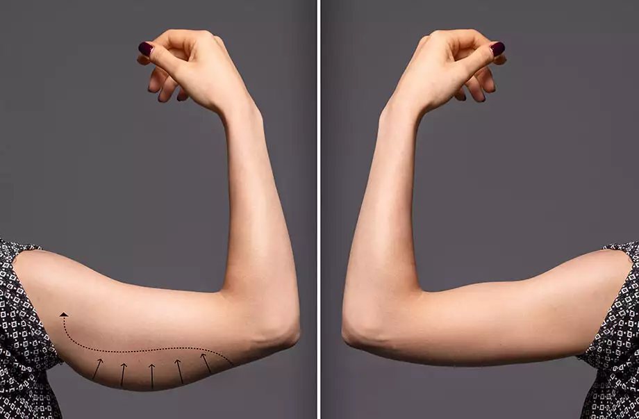 Arm Lift In Turkey | Affordable Upper Arm Contouring