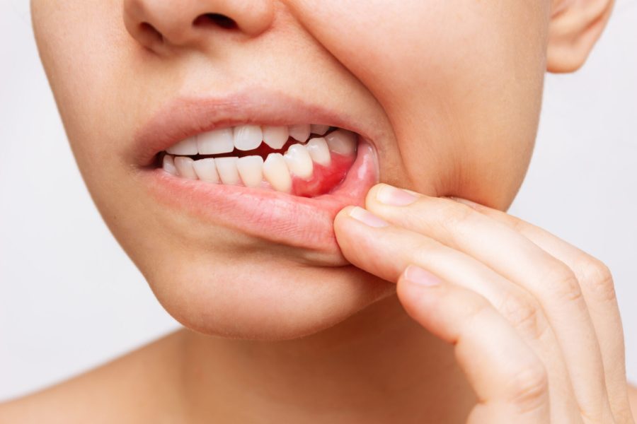 5 Receding Gums Stages To Watch Out For