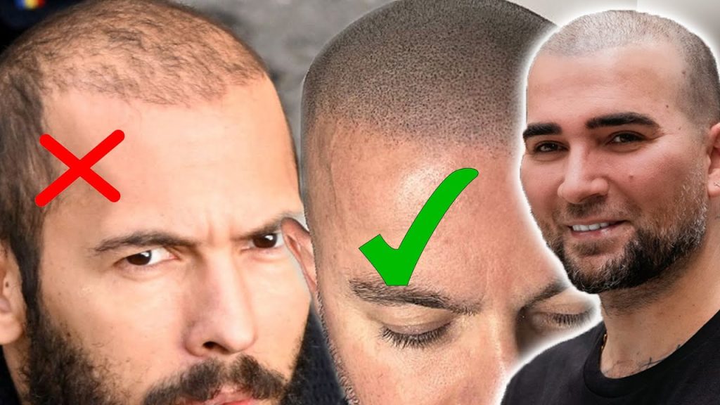 Andrew Tate Hair Transplant: The Speculation And The Truth About Hair ...