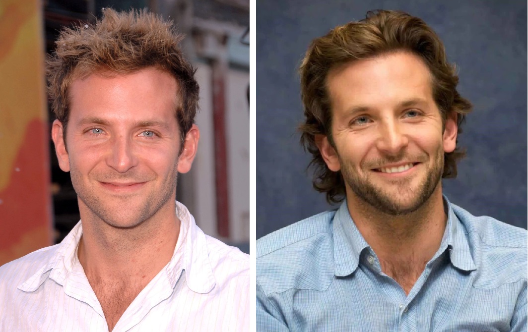 Bradley Cooper And Hair Transplants: Did The Hollywood Star Restore His ...