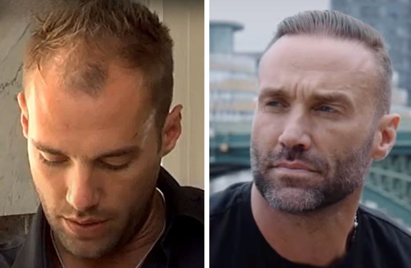 Calum Best Hair Transplant Journey: A Path To Confidence And Transformation