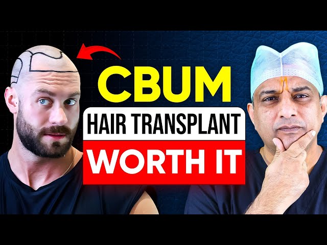 Chris Bumstead (CBum) Hair Transplant: Rumors, Reality, And The Journey ...