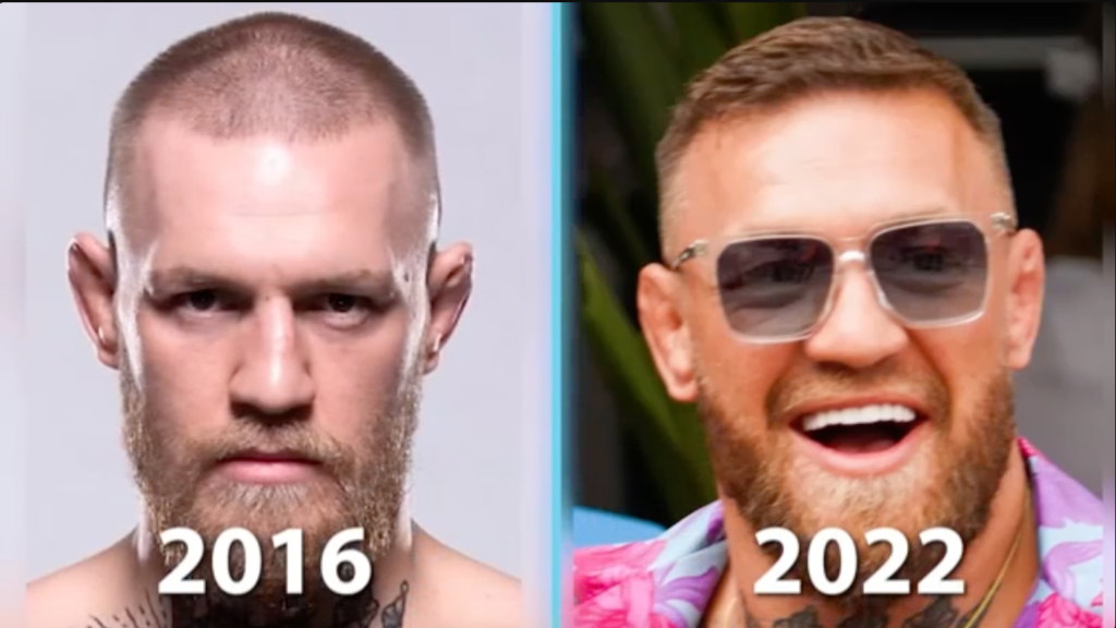 Conor McGregor Hair Transplant: A Closer Look At The MMA Star’s Hair ...