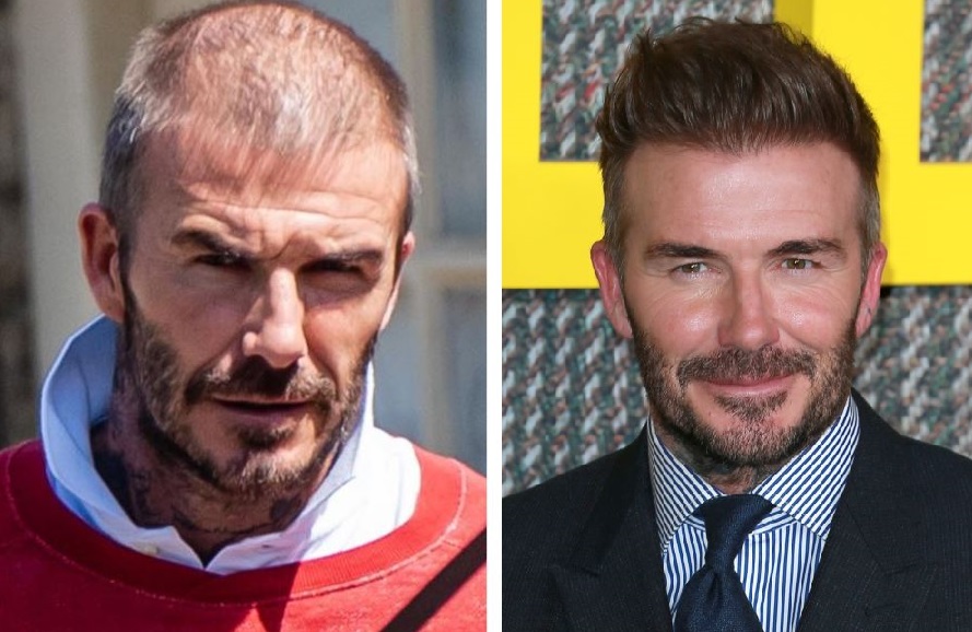 David Beckham Hair Transplant: Unveiling The Truth Behind His Hair ...