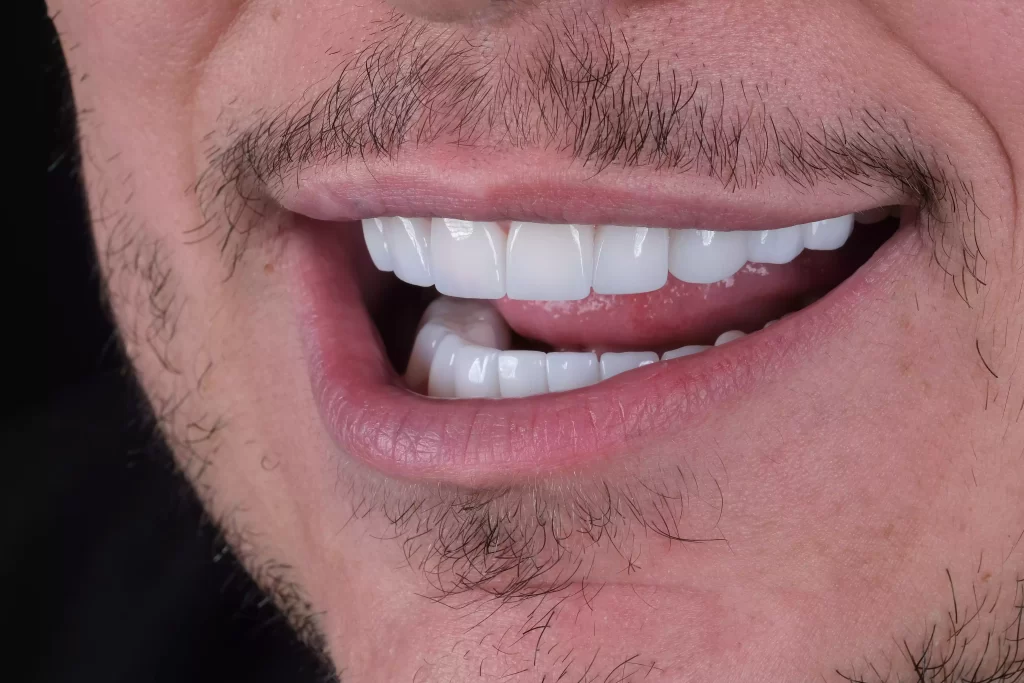 Emax Veneers: Transforming Smiles With Cutting-Edge Technology