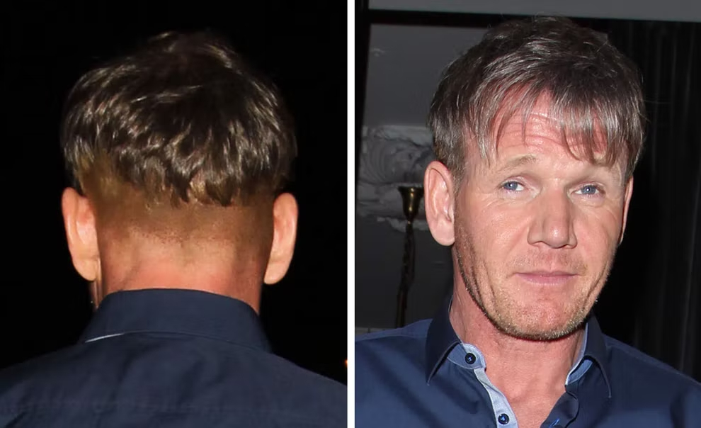 Gordon Ramsay Hair Transplant: Did The Celebrity Chef Restore His Hairline?