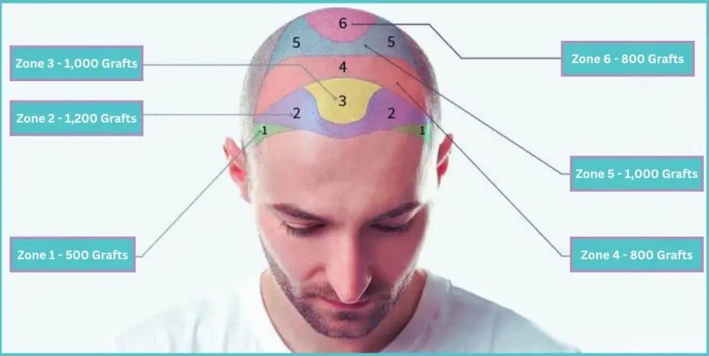 How Many Hair Grafts Do I Need? A Guide Using The Norwood Scale