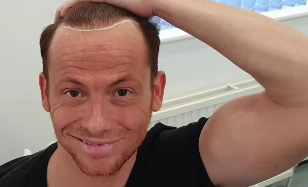 Joe Swash Hair Transplant Journey: A Story Of Confidence And Transformation