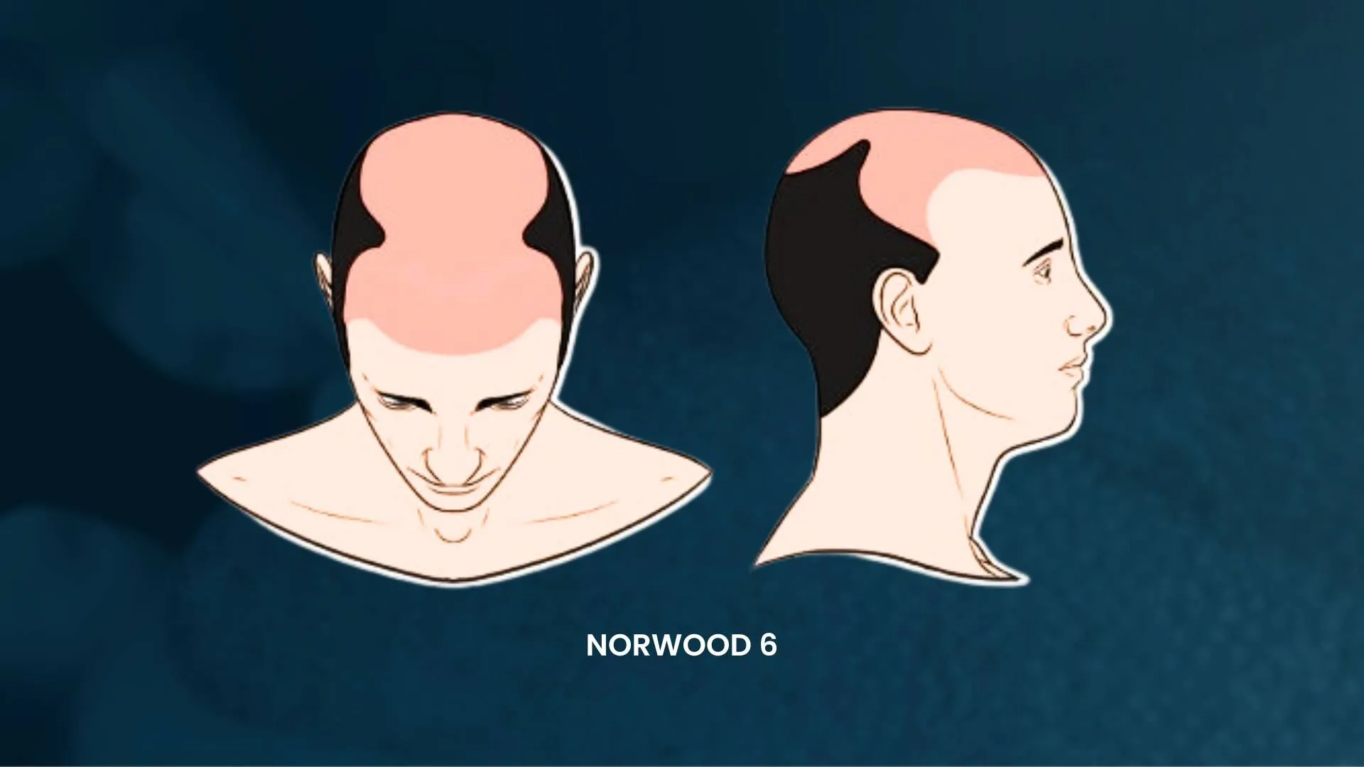 Hair Transplant For Norwood Scale 6: Transforming Advanced Hair Loss