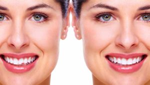 Tooth Reshaping: Procedure, Benefits, Risks, And Cost
