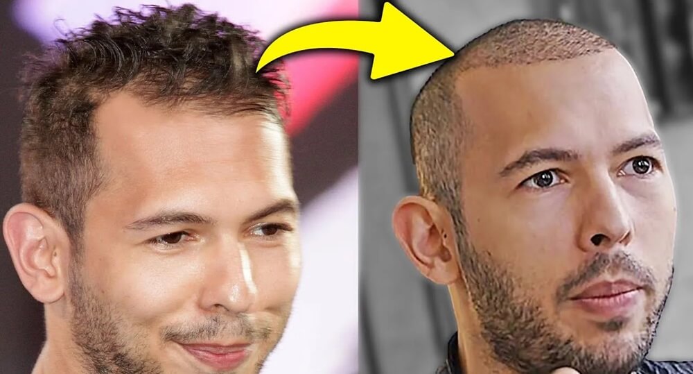 Tristan Tate Hair Transplant Journey: Confidence Restored