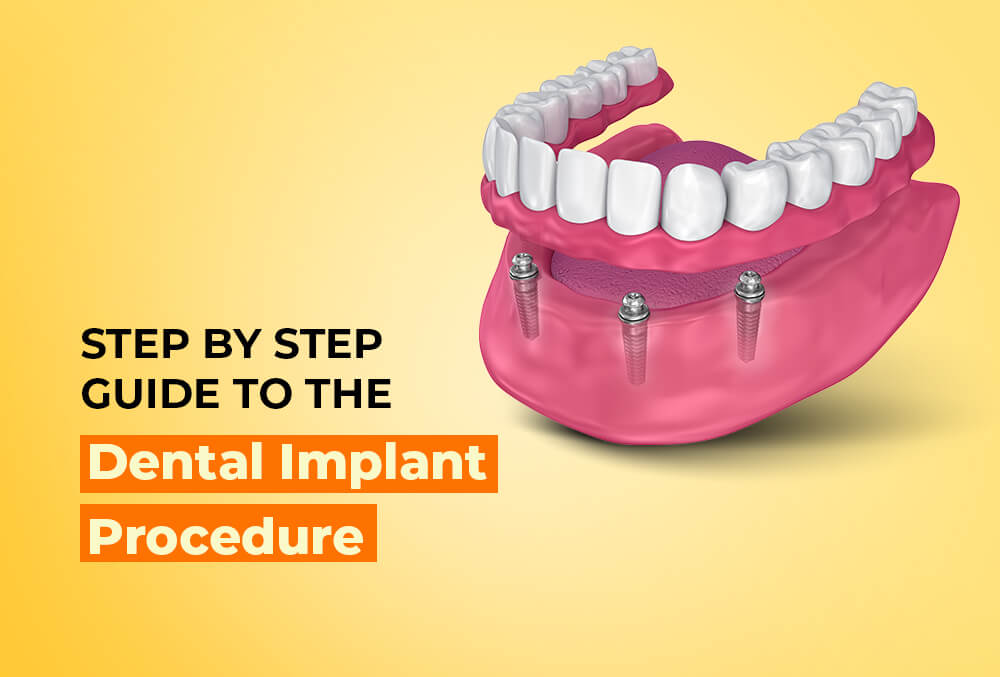 A Comprehensive Guide To The Dental Implant Procedure: Step-by-Step Breakdown