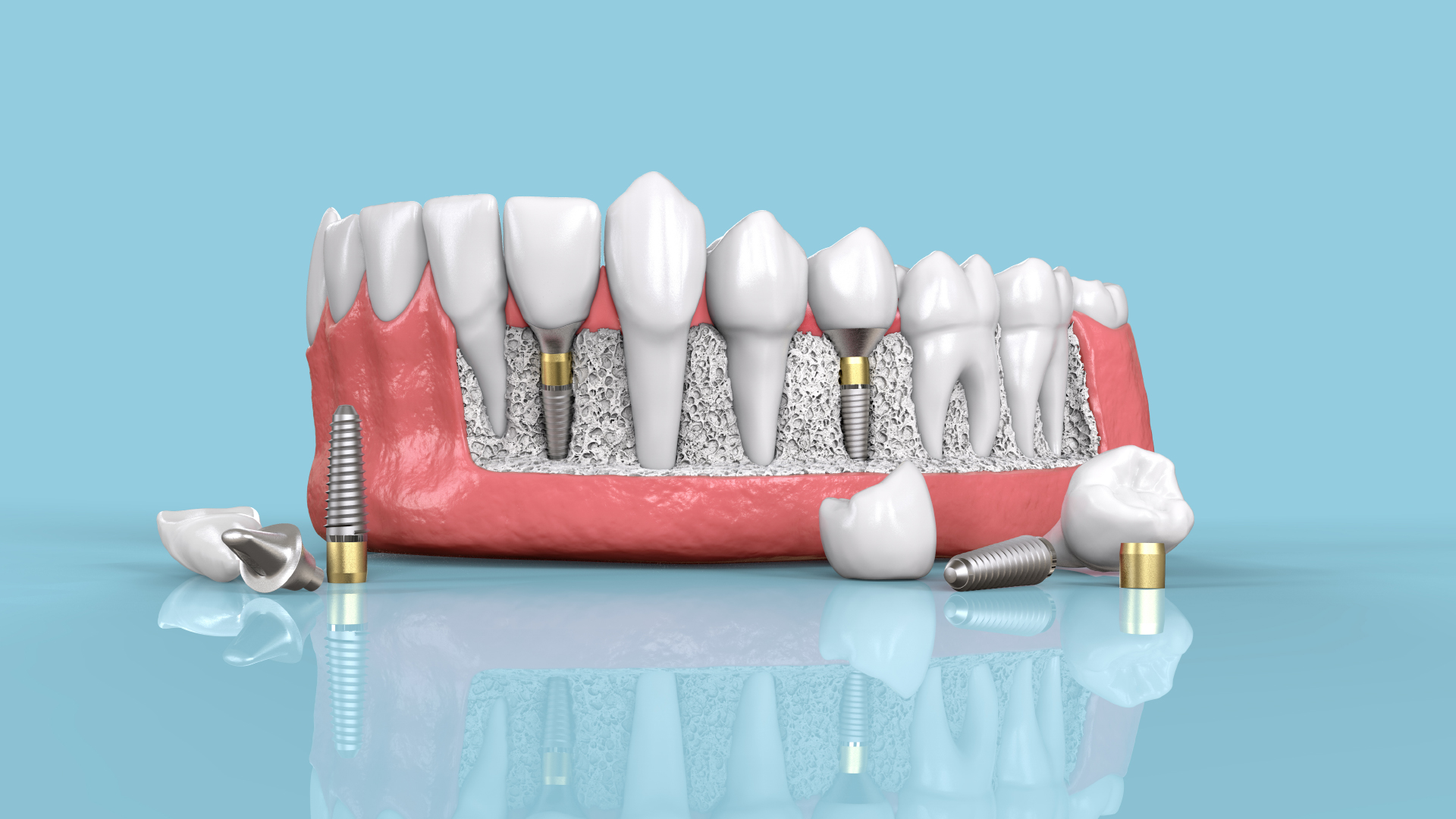 Differences Between All-On-8 Dental Implants Vs All-On-4 & All-On-6