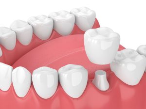 Dental Crown Repair: Procedure Steps And Costs Explained