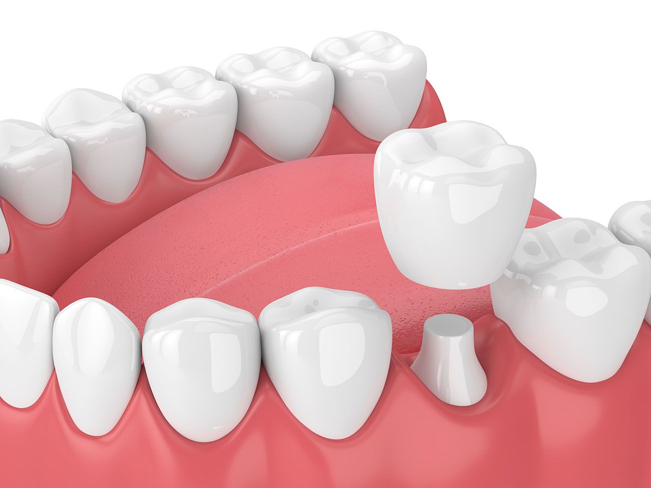 Dental Crown Repair: Procedure Steps And Costs Explained