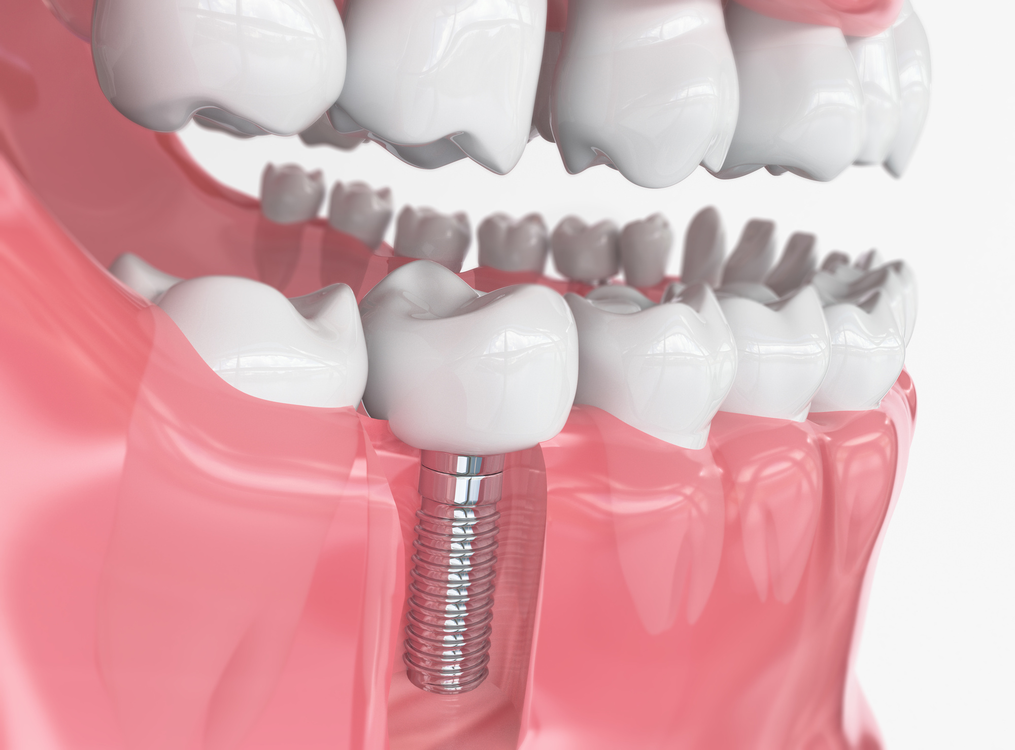 Different Types Of Dental Implants: A Comprehensive Guide