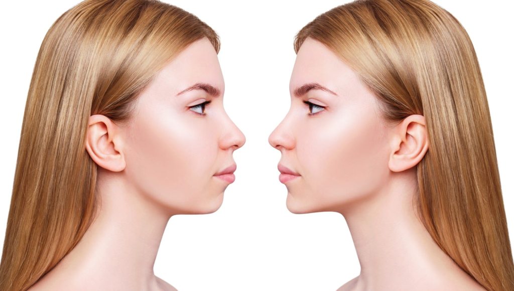 Double Jaw Surgery (Bimaxillary Osteotomy) In Turkey: A Comprehensive Guide