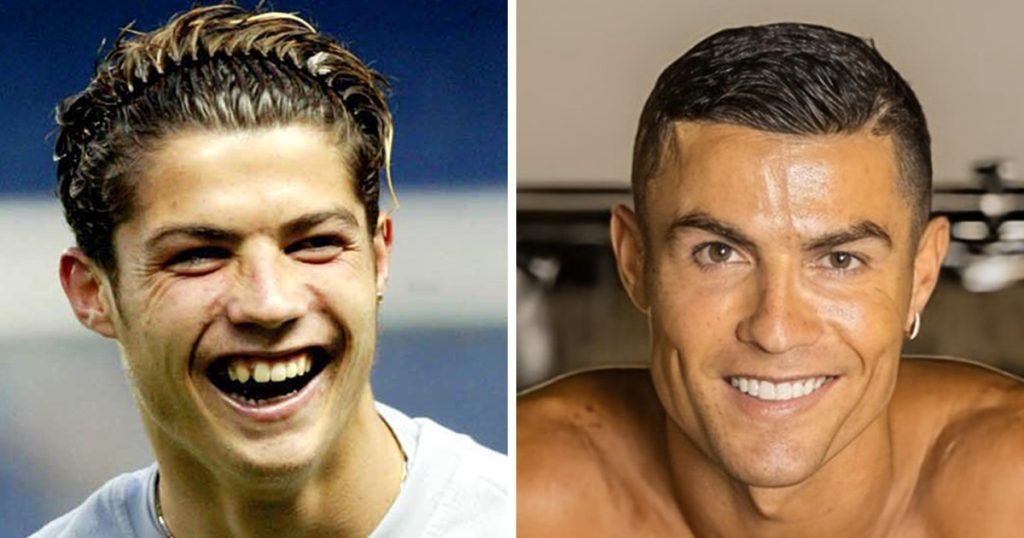 Get A Hollywood Smile Like Cristiano Ronaldo: The Cosmetic Treatments ...