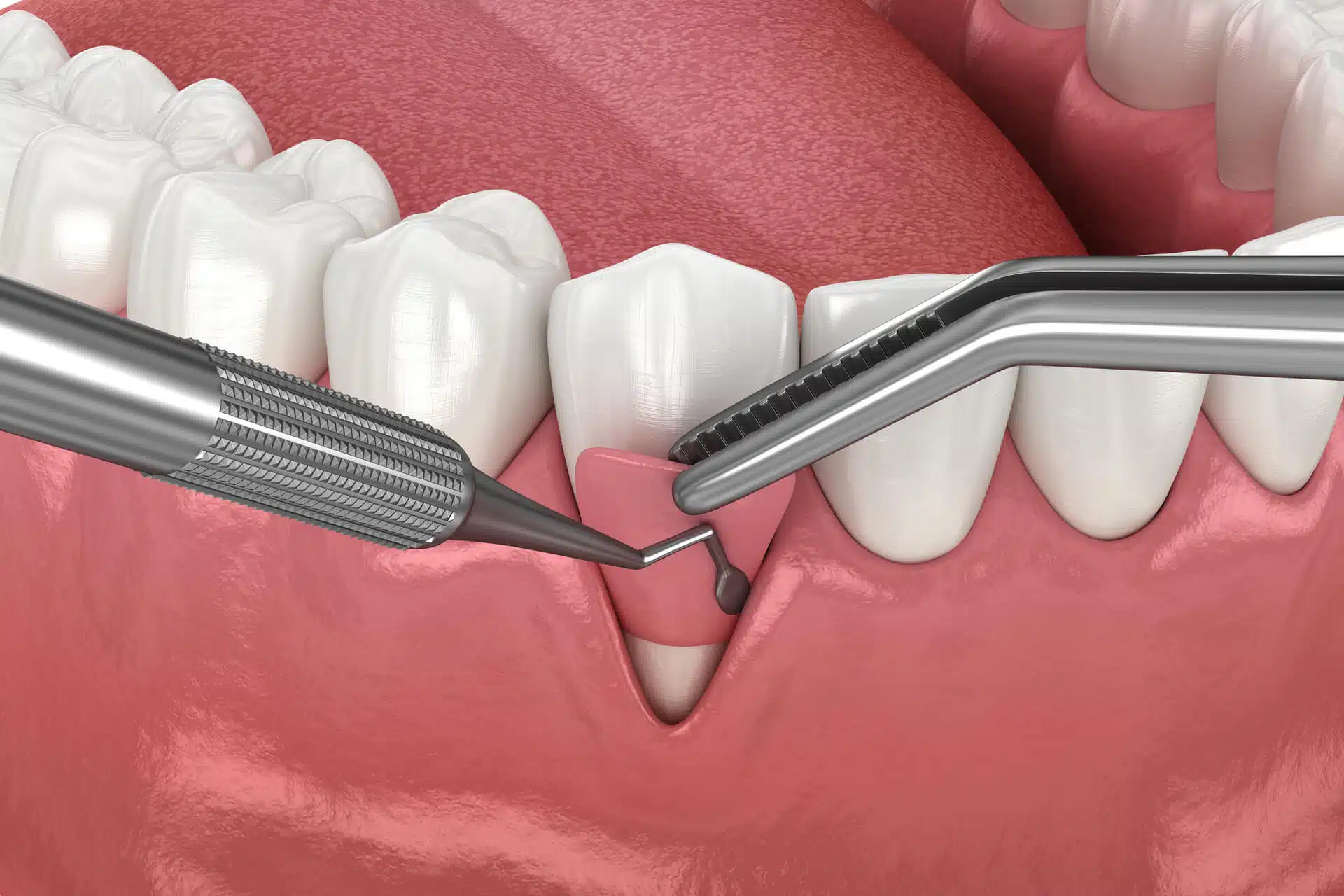 Gum Graft Surgery: Types And Recovery Insights