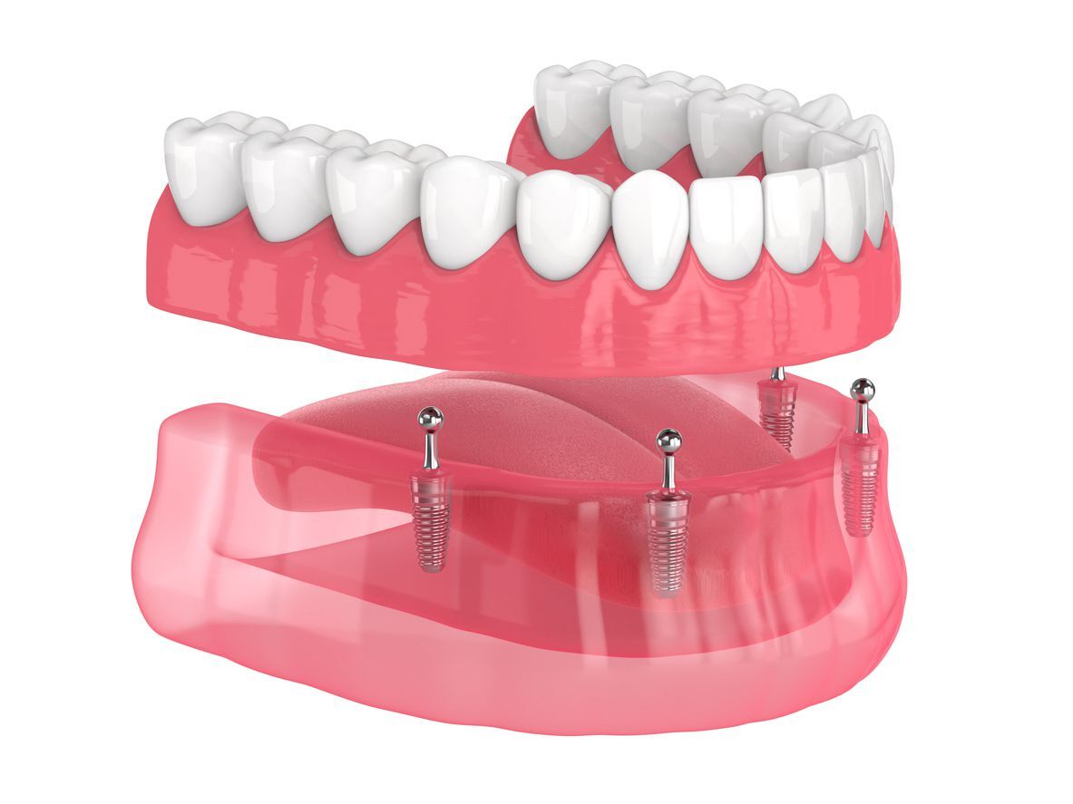 Mini Dental Implants: What They Are And How They Work