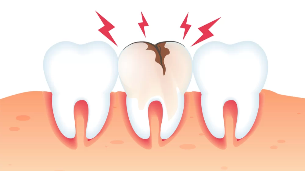 Repairing A Chipped Tooth: Your Complete Guide To Treatment Options