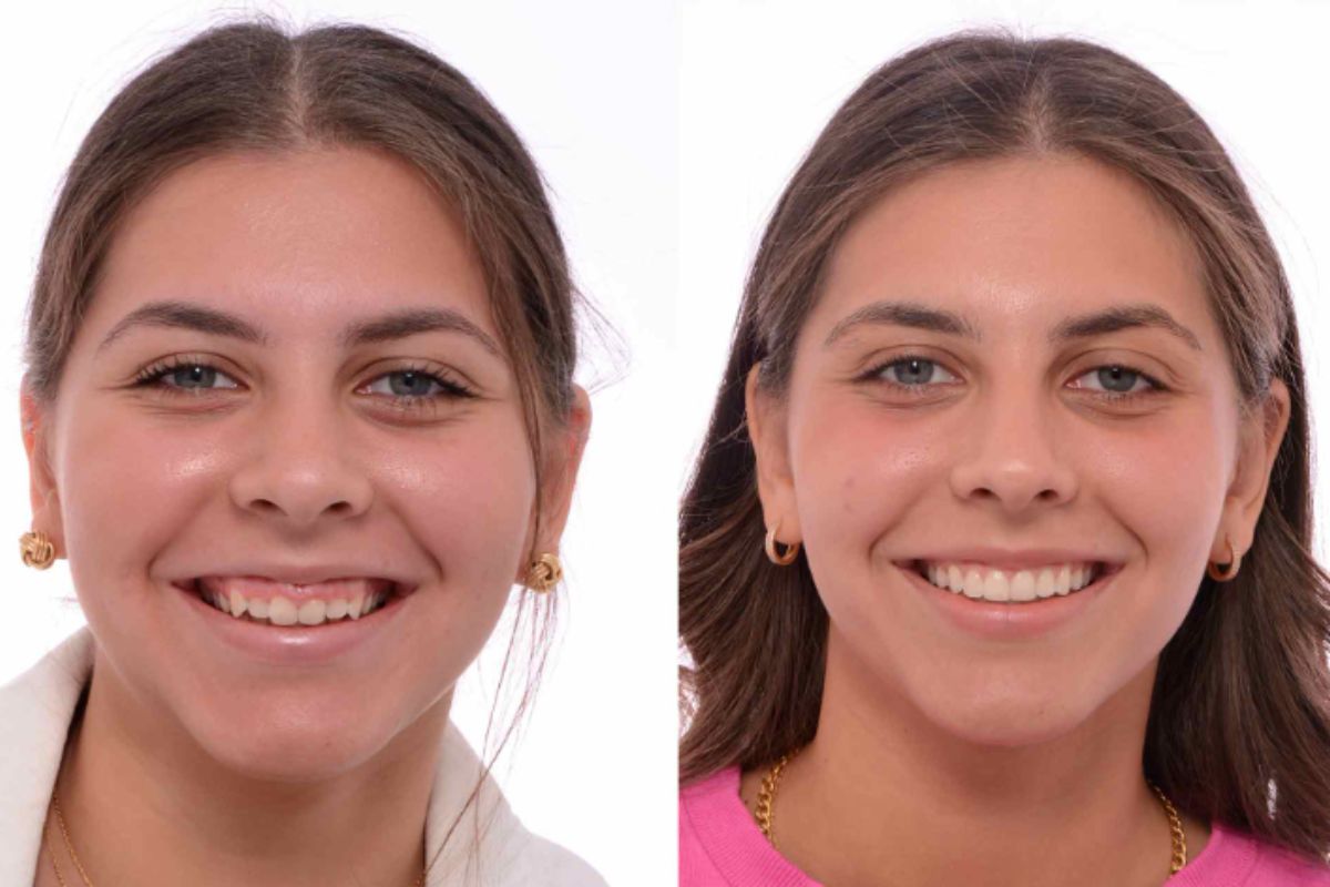 Understanding Gummy Smiles: Causes And Treatment Options