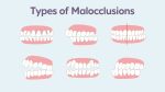 Understanding Malocclusion: Types, Causes, And Effective Treatment Options