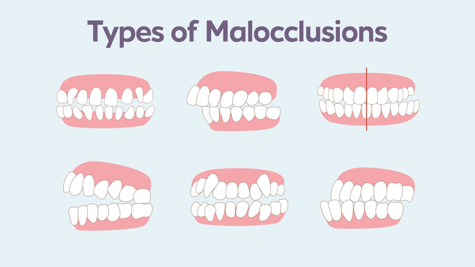 Understanding Malocclusion: Types, Causes, And Effective Treatment Options