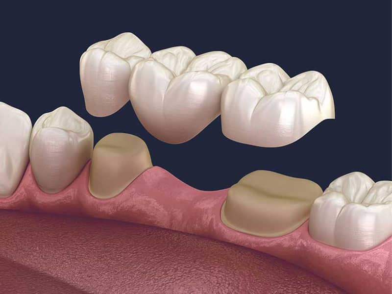 Understanding The Dental Crown Procedure: A Step-by-Step Guide