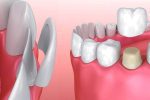 Veneers Vs. Crowns: Key Differences, Similarities, And Cost Comparison